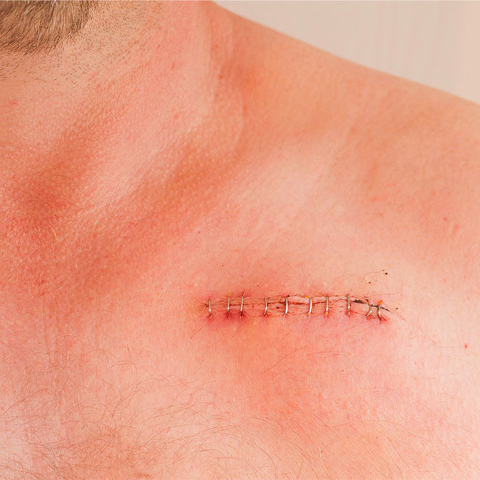 Cicatrices : Comprendre leurs différences pour mieux les traiter ...